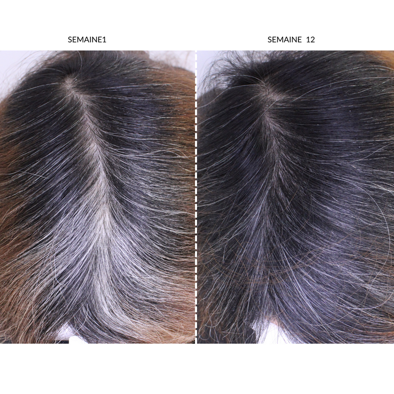 Casque LED contre la perte de cheveux | Casquette laser repousse ...